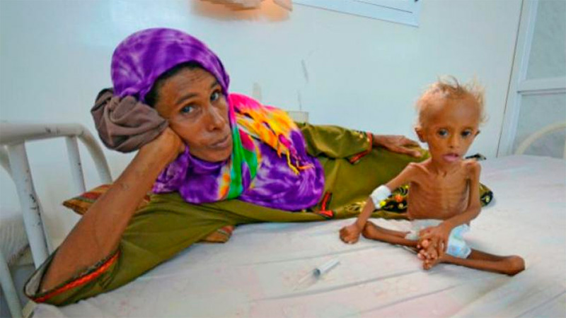El niño desnutrido de Yemen que conmovió al mundo | Elonce.com